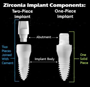 Ceramic Implants - Dental BioHealth